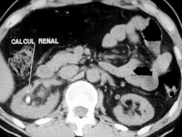 Uroscanner : comment se déroule cet examen urinaire